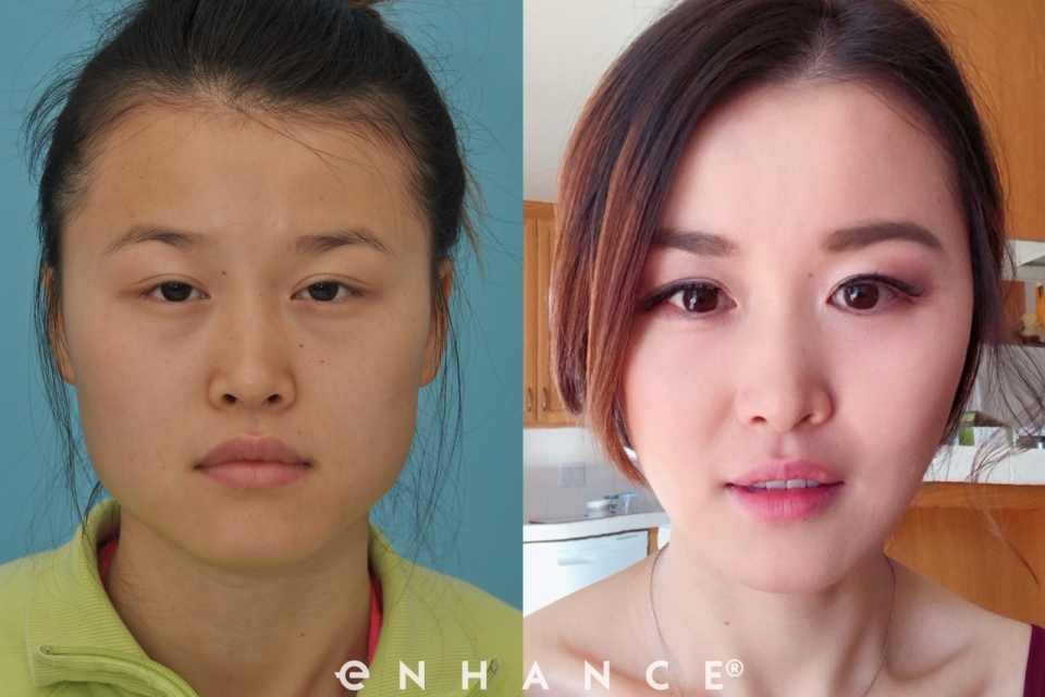 Cheek Reduction Photos - Enhance® Medical Center | Beverly Hills, CA