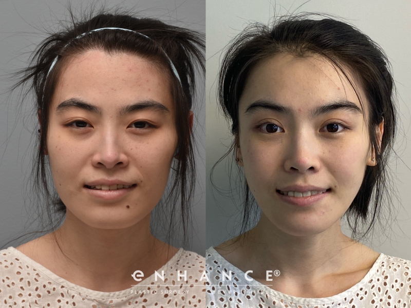Cheek Reduction Photos - Charles S. Lee, MD | Beverly Hills, CA