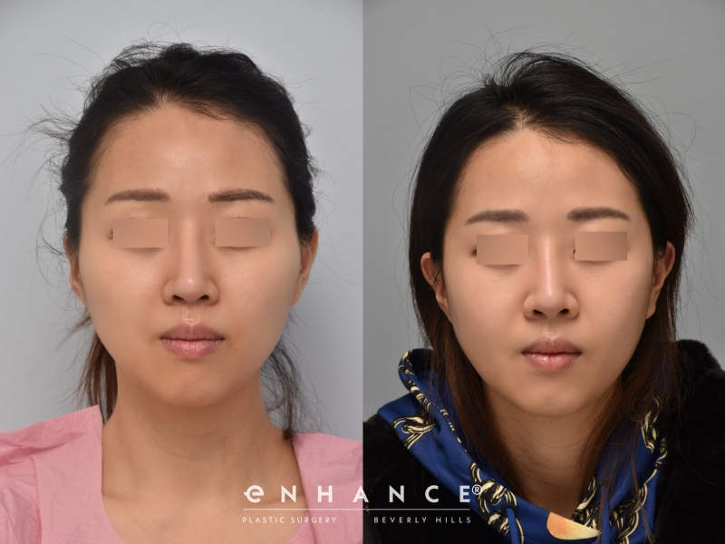 Cheek Reduction Photos - Charles S. Lee, MD | Beverly Hills, CA