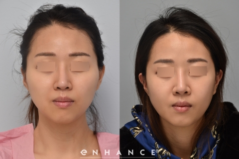 Cheek Reduction Photos - Enhance® Medical Center | Beverly Hills, CA