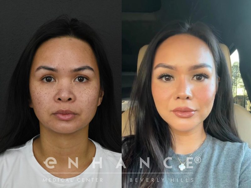 Chin Augmentation Photos - Charles S. Lee, MD | Beverly Hills, CA