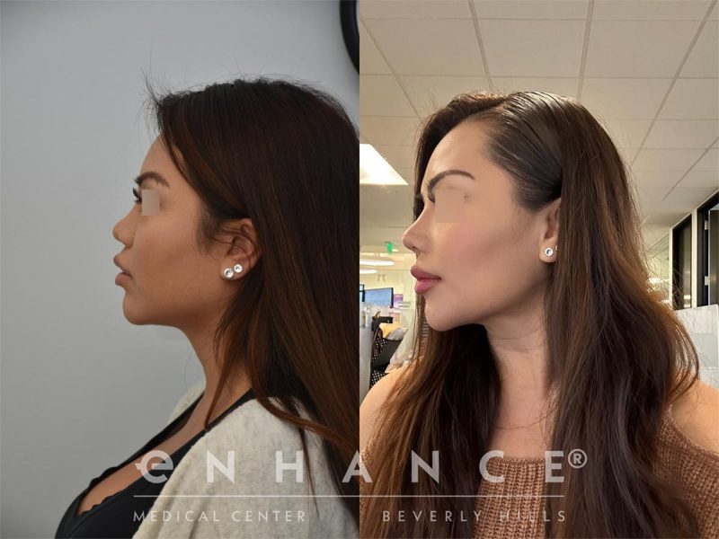 Chin Augmentation Photos - Charles S. Lee, MD | Beverly Hills, CA