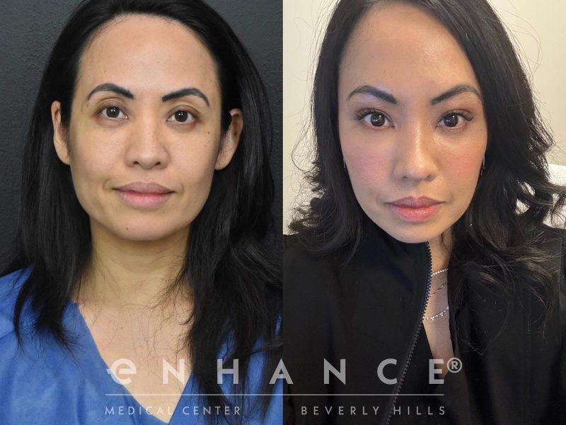 Endoscopic Face & Temple Lift Photos - Charles S. Lee, MD | Beverly ...