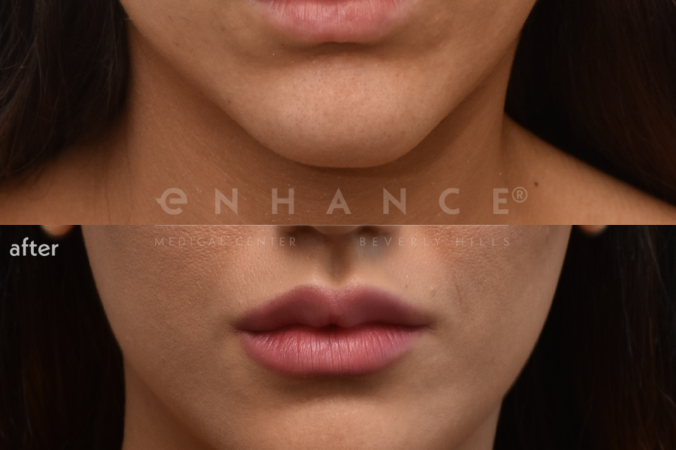 Jaw Augmentation Photos - Enhance® Medical Center | Beverly Hills, CA