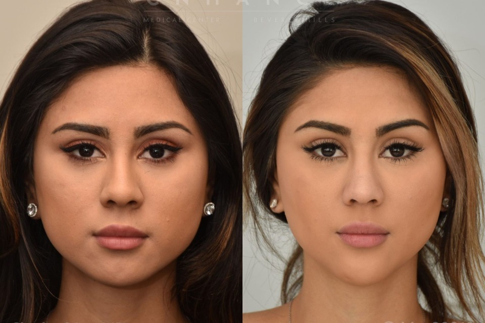 Jaw Augmentation Photos - Enhance® Medical Center | Beverly Hills, CA