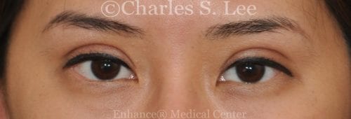 “Anchor” incision technique: what makes it different | Charles S. Lee, MD