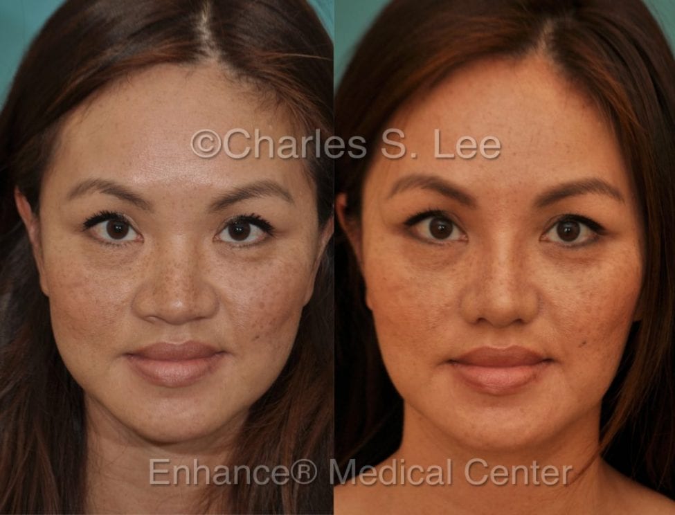 Alarplasty – nostril narrowing | Charles S. Lee, MD