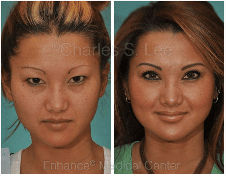 Asian Eyelid Surgery Can Give You the Look You Want | Charles S. Lee, MD