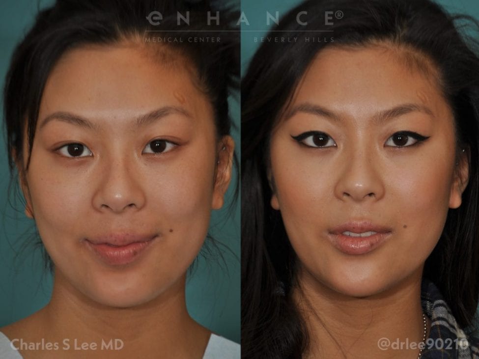 Jaw Reduction Archives | Charles S. Lee, MD