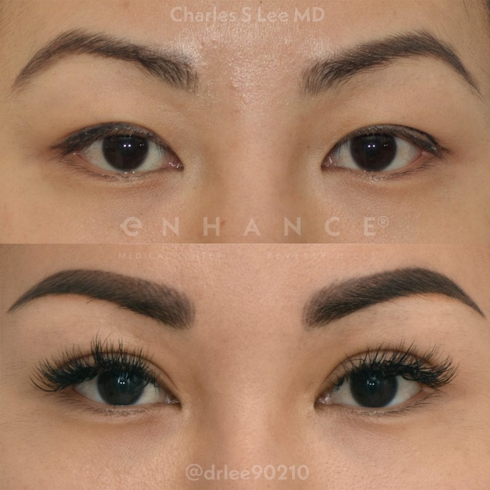 Epicanthoplasty