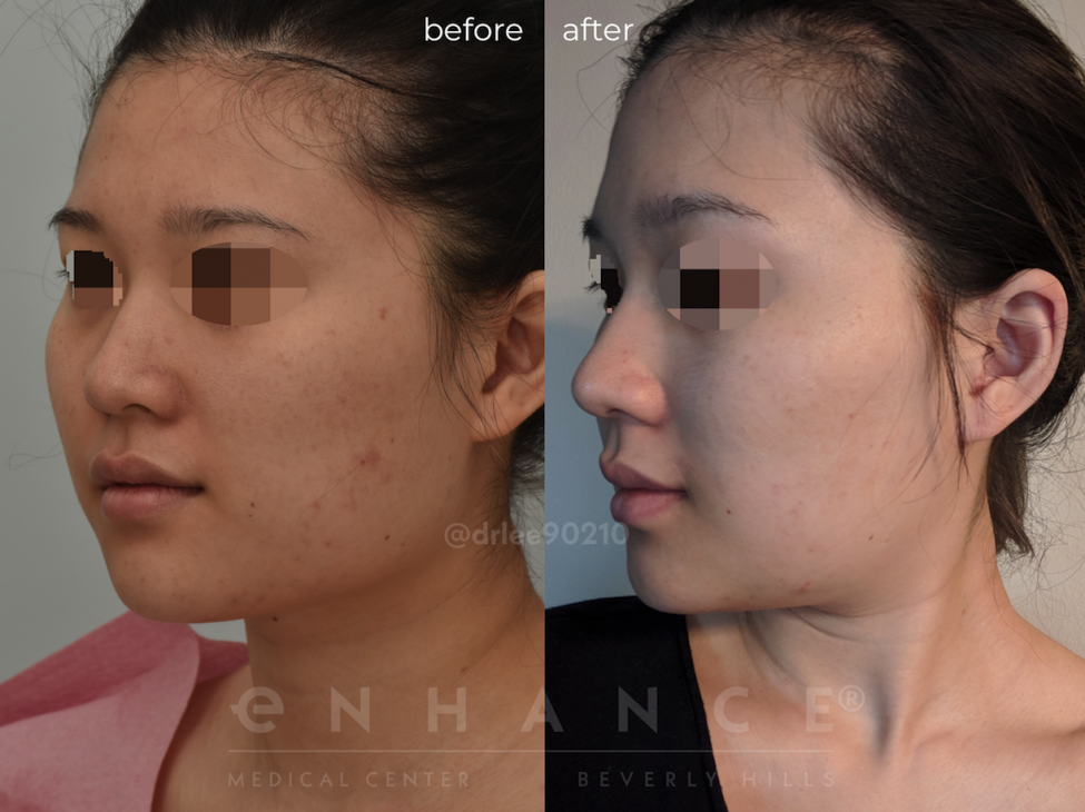 Jaw Reduction Archives | Charles S. Lee, MD