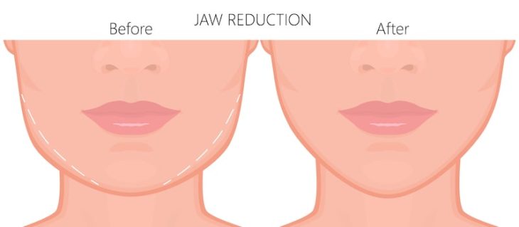 What Should I Expect From Jaw Reduction Surgery and Recovery? | Charles ...